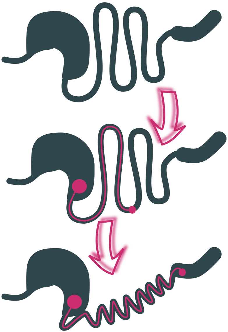 KICK ASS Red Rubber Feeding Tube Technique for Linear Foregin Bodies