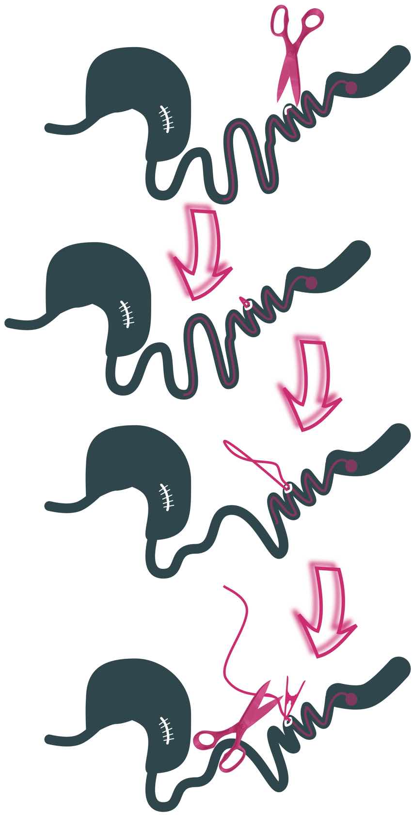 KICK ASS Red Rubber Feeding Tube Technique For Linear Foregin Bodies